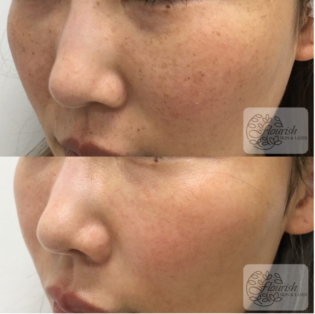 Laser Pigmentation Removal – Flourish Skin and Laser Studio